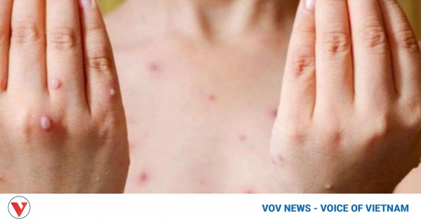 Most local monkeypox cases have infectious syndrome caused by HIV